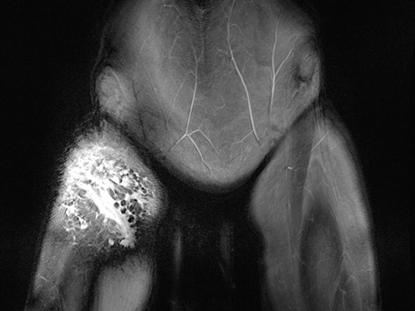 Compva: Course of a lymphatic malformation with lymphorrhea