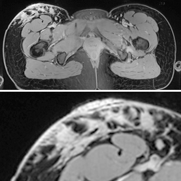 Compva: Course of a lymphatic malformation with lymphorrhea