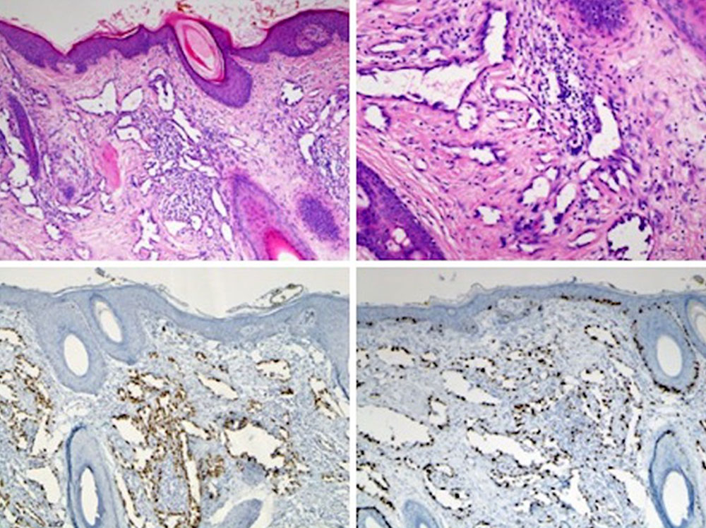 Compva: Angiosarcoma